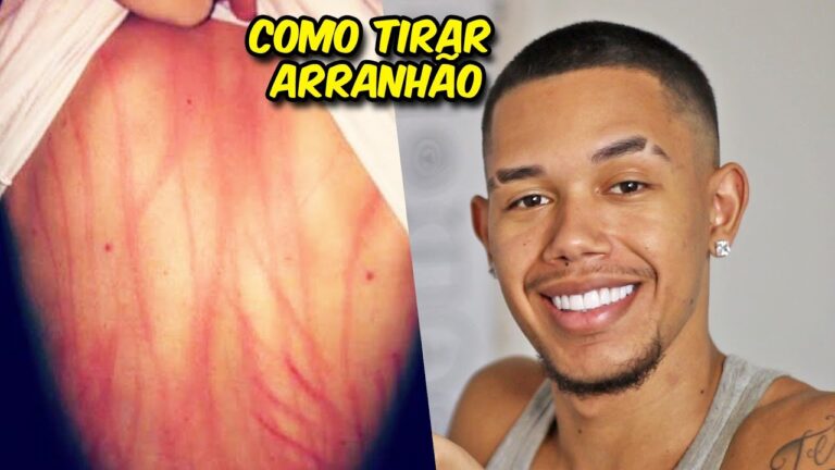 Como Tratar uma Marca de Arranhão na Pele | Actualizado enero 2026